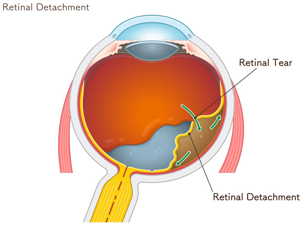 Retinal Detachment - P W Optics